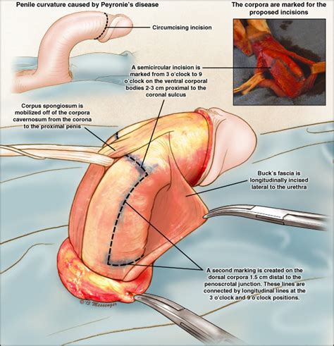 Coronal Sulcus