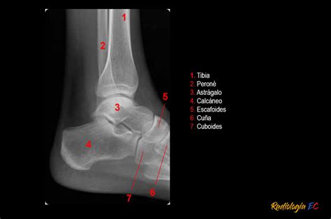Radiografia De Tobillo