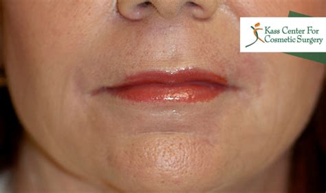 Hetter Chemical Peel Resurfacing St Petersburg And Clearwater