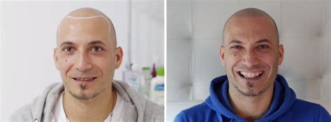 Scalps Scalp Micropigmentation Centers How To Hide A Fut Scar When