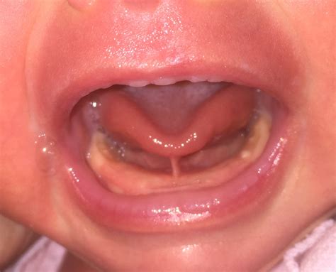 Oral Thrush Babies Gums