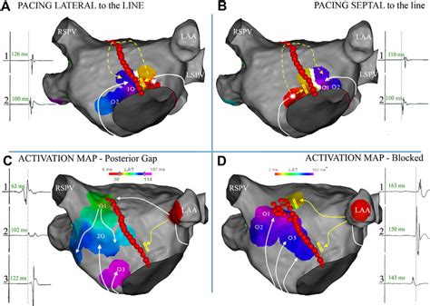 A Activation Map Pacing Lateral To The Line Close To The Mitral Download Scientific Diagram