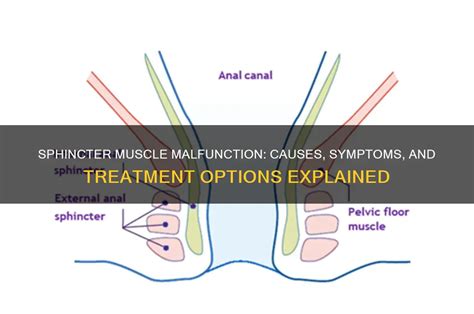 Sphincter Muscle Malfunction Causes Symptoms And Treatment Options Explained Cyvigor