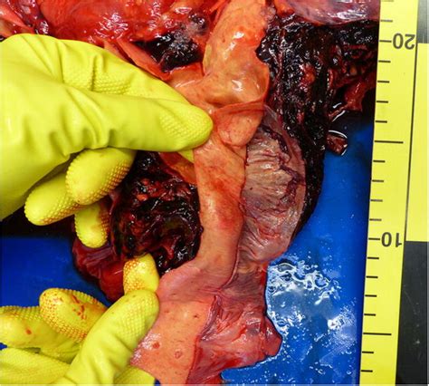 Upper Segment Of The 32 Cm Long Aortic Dissection Download Scientific