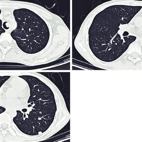 Ct Scan Showing The Main Bronchus Mass And Multiple Nodules In The