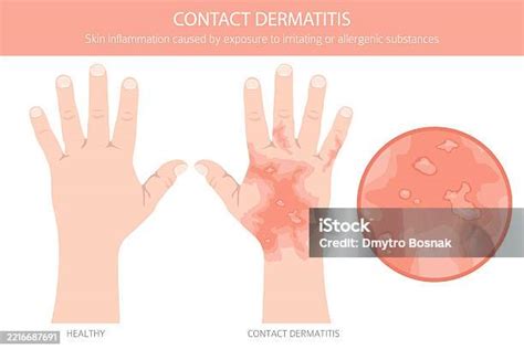 Dermatitis Kontak Penyakit Kulit Desain Infografis Medis Ilustrasi Stok