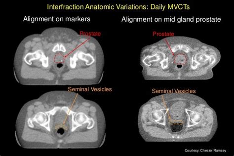 Kupelian 2nd Talk Prostate Igrt Hyderabad 2013 Kupelian