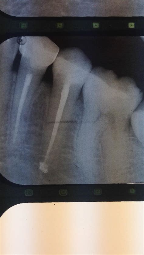 Root Canal Gone Wrong Been Three Weeks And I Still Cant Feel Half