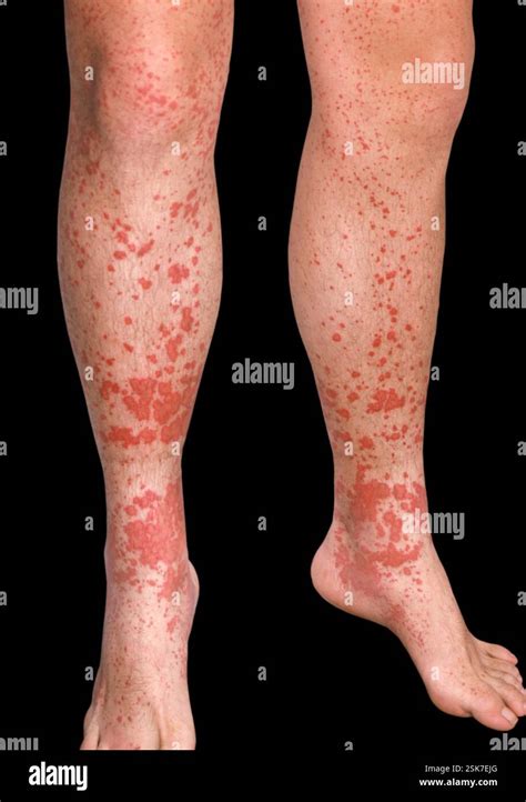 Purpura Rash On The Lower Legs Of A 34 Year Old Male Patient Purpura
