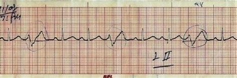 Ventricular Trigeminy A Vizsla With Ventricular Premature Complexes