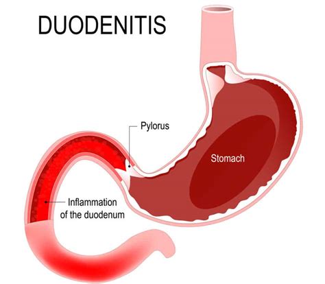 Peptic Duodenitis