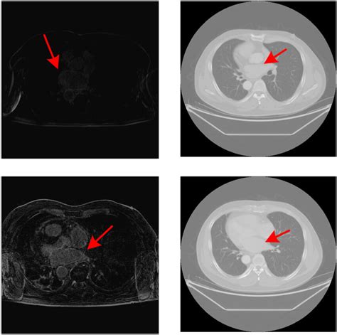 Mri And Ct Slices Of The Left Atrium In Four Patients The First Column Download Scientific