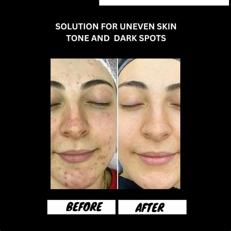 Solution For Uneven Skin Tone And Dark Spots Organic And Herbal Solutions
