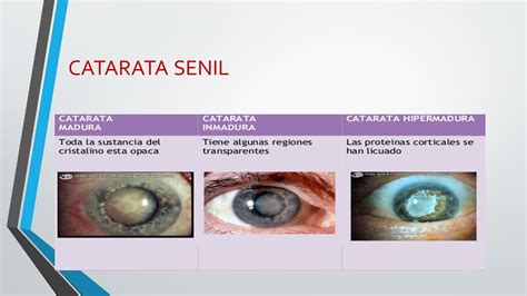 Clí Tipos De Cataratas