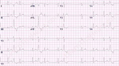 Expert Ecg 10