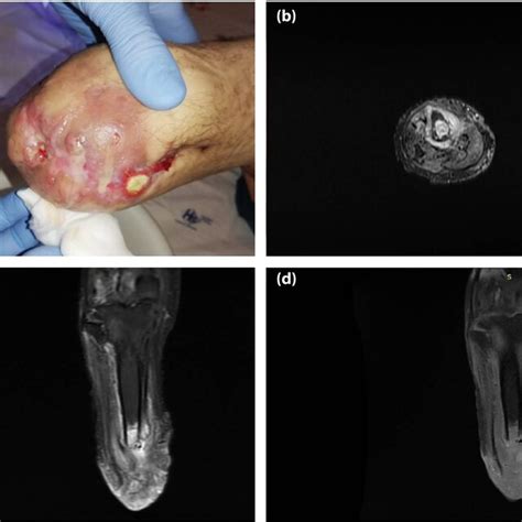 A Clinical Signs Of Infection Of The Patients Residual Limb During