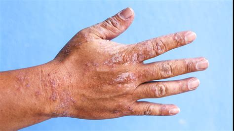 Itchy Bumpy Rash On Hands And Feet Rash 22 Common Skin