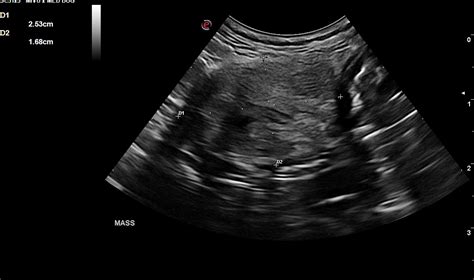 Incidental Abdominal Mass