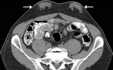 Imaging Of Abdominal Wall Masses Masslike Lesions And Diffuse