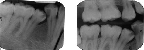 Case Of The Week Ectopic Eruption Dr Gs Toothpix