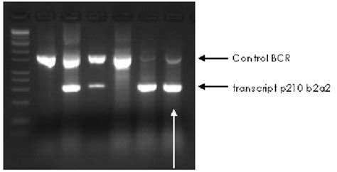 Pcr Analysis For Identification Of Bcr Abl Transcript Patient Suub Download Scientific