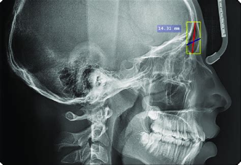 Lateral Cephalogram Showing The First Protocol For Measuring The Sinus Download Scientific