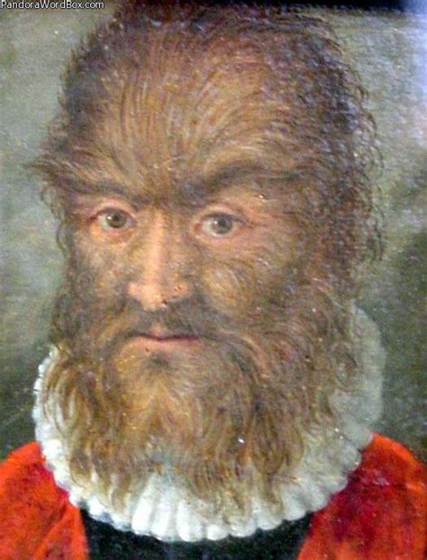 Hirsutism Hirsute Hirsutism Hair Hairy Mendelian Single Gene Autosomal Dominant Phenotype