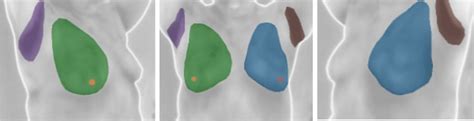 the outcome of the breast segmentation model colors indicate