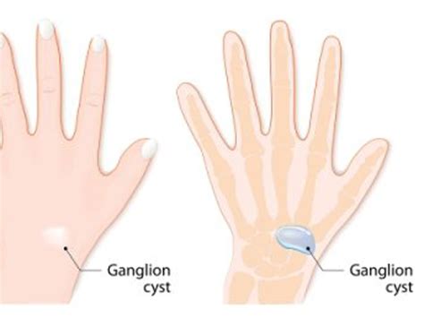 Ganglion Cyst What Are The Causes Of Ganglion Cysts