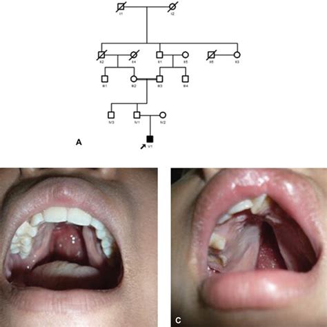 Type Of Consanguinity Of Patients With Ns Clp Download Scientific