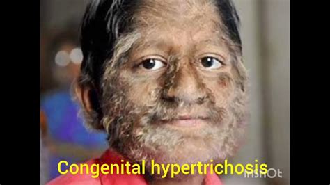 Congenital Hypertrichosis Youtube
