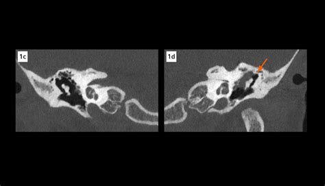Congenital Cholesteatoma