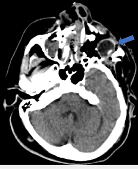 Figure 2 From Traumatic Globe Luxation And Optic Nerve Avulsion A Case