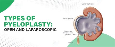 Types Of Pyeloplasty Open And Laparoscopic