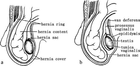Inguinal Hernia Wikism Sports Medicine Wiki