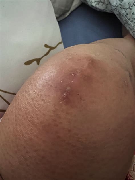 10 My Acl Journey Return To Work And An Unexpected Suture Abscess