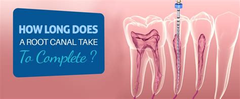 How Long Does A Root Canal Take To Perform Detroit Chinatown
