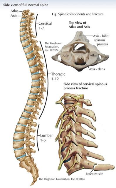 Spinous Process Fractures Hughston Clinic