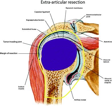 Proximal Humerus Tumors Musculoskeletal Key