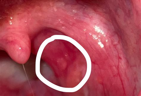 Ulcer On Tonsil