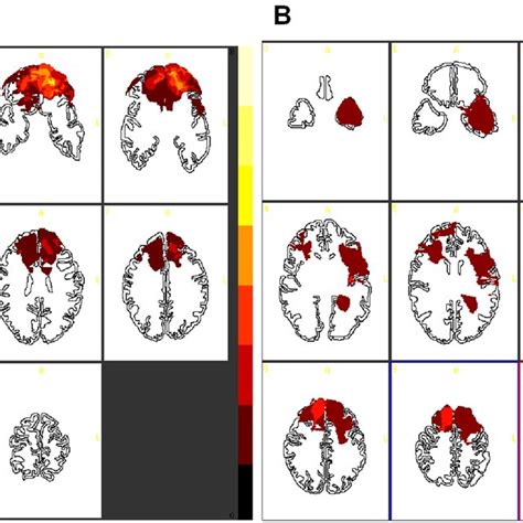 Reconstruction Of Lesions For Each Patient With Frontopolar Cortex