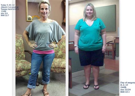 Before And After Tummy Tuck Scars Boolupdates