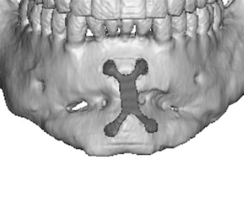 Assessment Of Bone Healing Across The Grafts Interpositional Gap In