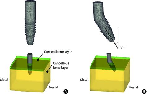 Finite Element Model Of The Implant Abutment And Artificial Bone