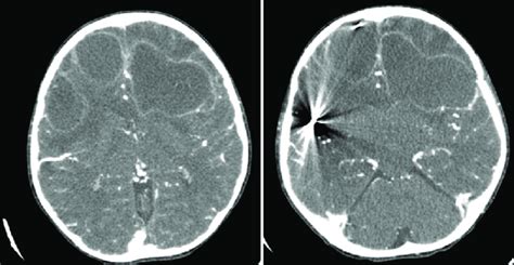 Multiple Brain Abscess In Axial Cut Of Intravenous Iv Contrast Brain Download Scientific