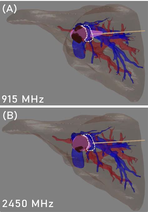 Figure 1 From Simulation Of Image Guided Microwave Ablation Therapy