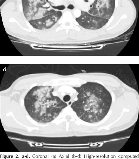 Figure 2 From An Index Case Of Diffuse Alveolar Hemorrhage Secondary To Chikungunya Semantic