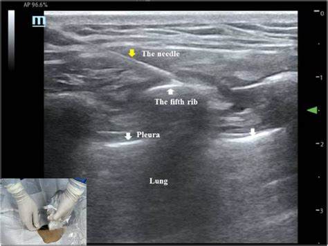 ultrasound guided serratus anterior block procedure download