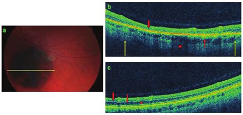 A Color Fundus Photograph Of The Left Eye Shows The Flat Congenital Download Scientific