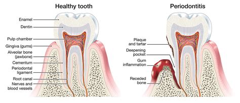 Periodontitis The Perio Specialists And Dental Implants